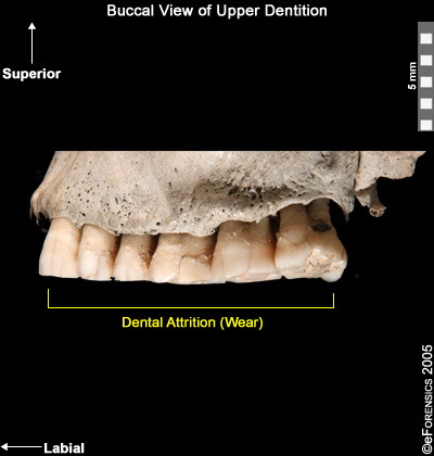 Age Estimation – FORENSICS