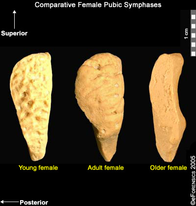 Pubic Symphysis Age Determination