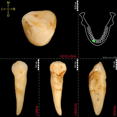 Dentition: Canines – FORENSICS