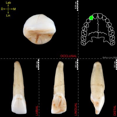 Dentition: Incisors – FORENSICS